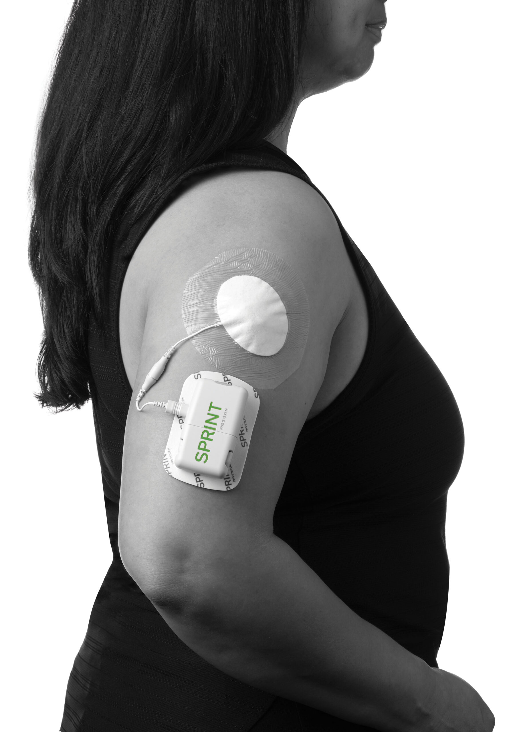 Sprint PNS System in Bloomsburg and Lock Haven, PA | PA Pain Physicians